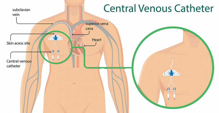 Liver Cancer Treatments - Central Venous Access Devices