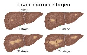 The Different Stages of Liver Cancer | USA Oncology Centers